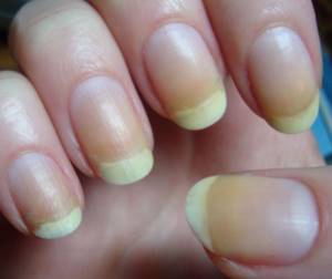 What causes yellowish fingernails and how to get rid of them