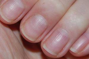 Beau's lines (Beau-Reil's furrows) on nails: causes, treatment in ...